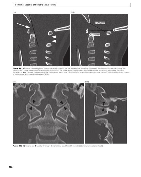 Atlanto Occipital Dislocation Case 48 Clinical Imaging Of Spinal Trauma