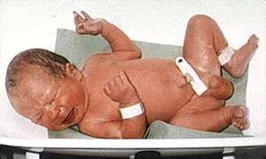 Dysfonction érectile Un bébé garçon devrait il être circonci