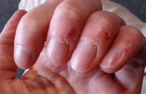 Pterygium Nail Signs Causes Treatments Naildesigncode