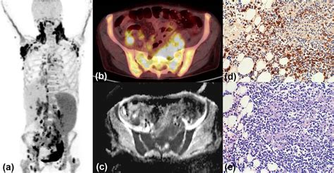 Bone Marrow Involvement In Malignant Lymphoma Academic Radiology