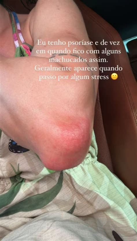 Juju Salimeni impressiona seguidores ao mostrar mancha causada por doença