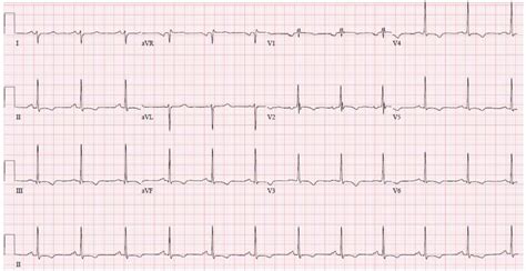 A Unique Case Of Right Axis Deviation Circulation