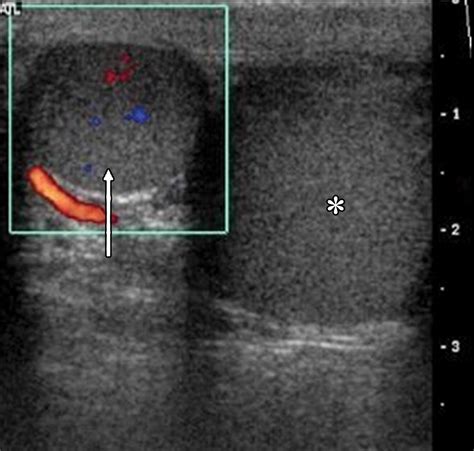 Spectrum Of Extratesticular And Testicular Pathologic Conditions At