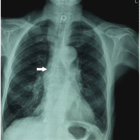 Chest X Ray Postero Anterior View Showing The Fragment Of The