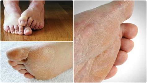 Hongos en los pies Síntomas causas y tratamiento natural