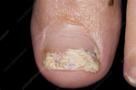 Fungal Infection Of The Toenail Stock Image C007 2700 Science