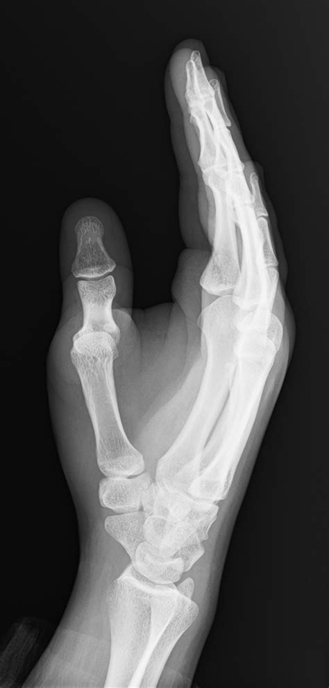 First Metacarpophalangeal Joint Dislocation Image Radiopaedia Org