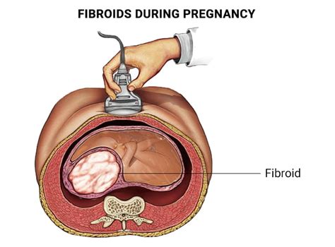 Fibroids During Pregnancy Vein Endovascular Medical Care