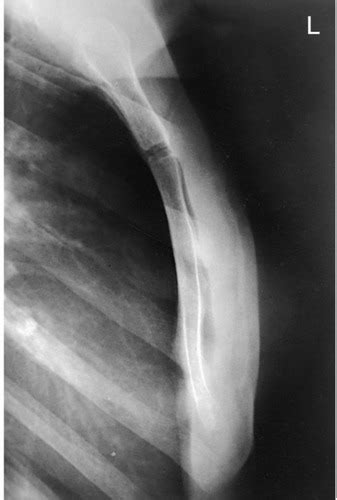 Bony Thorax Flashcards Quizlet