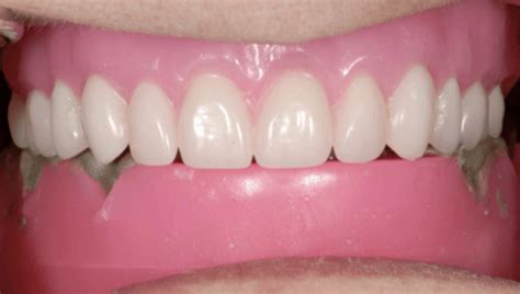 Am I Eligible For Dental Implants Nuvia Dental Implant Center