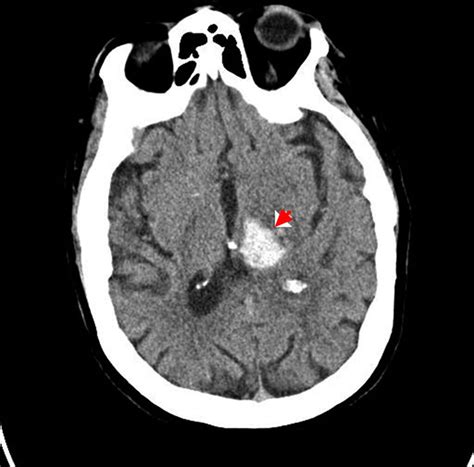 Intracranial Hemorrhage Cause Symptoms Diagnosis Treatment