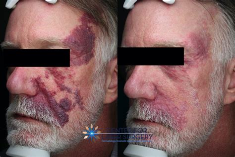 Port Wine Birthmark