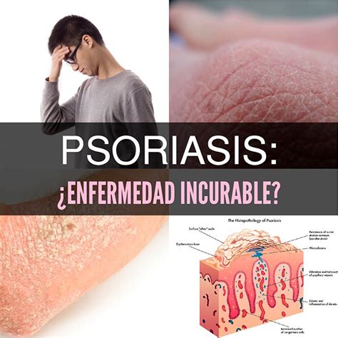 Psoriasis qué es causas síntomas y tratamiento La Guía de las