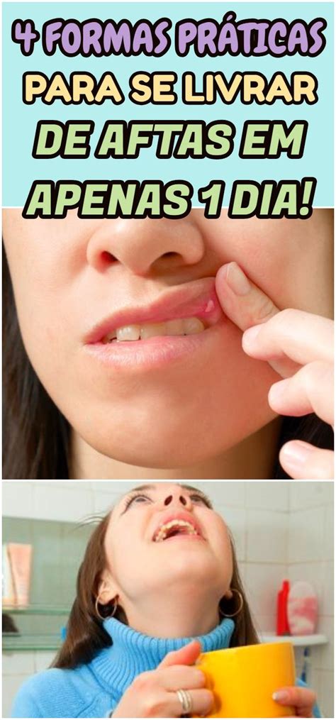 Imagens De Afta No Céu Da Boca As aftas são feridas bucais pequenas