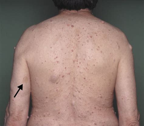 Von Recklinghausen S Neurofibromatosis Neurofibromatosis Type 1 The