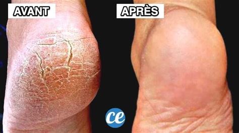 Une Ancienne Astuce Au Citron Pour Soigner Les Talons