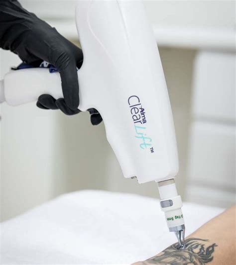Eliminación de tatuajes en Mallorca Mallorca DERMATIVA