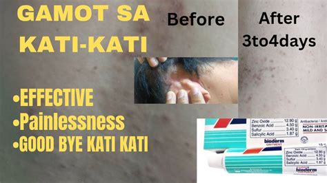 MABISANG GAMOT SA KATI KATI NG BALAT OR KATAWAN RASHES BONI INSECT