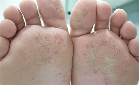 Hongos En Los Pies Causas S Ntomas Y Tratamientos Viralinsight