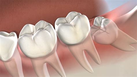Muelas Del Juicio Archivos City Dental