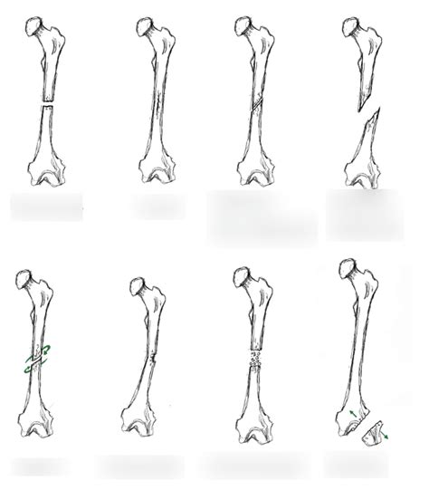 Diagram Of Fracture Types Quizlet