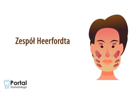 Zespół Heerfordta Portal Stomatologa