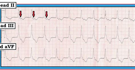 Ecg Interpretation Ecg Blog Ventricular Rhythms Aivr Vt