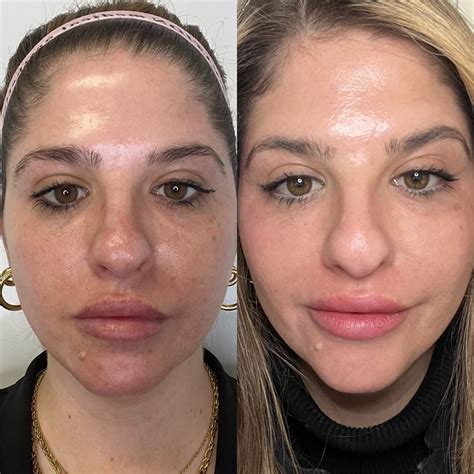 Co Resurfacing Laser Before During After Rma
