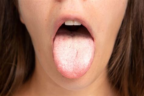 Candidiasis bucal cuáles son los síntomas y tratamiento
