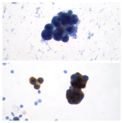 Effusions Cytopathology Cellnetpathology