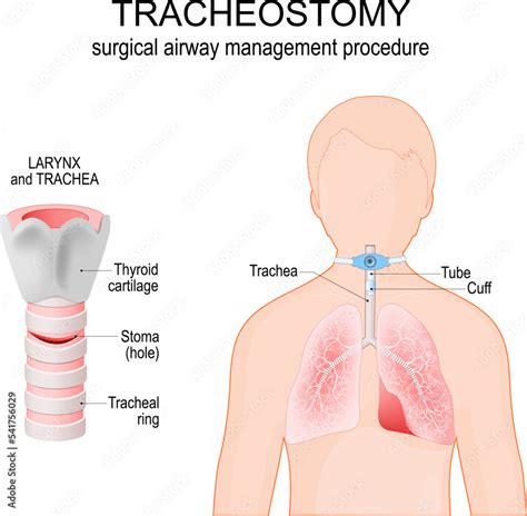 Tracheostomy Anatomy Of The Trachea With Stoma Larynx Stock Vector