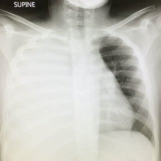 Frontal Chest Xray Showing Opacification Of The Right Hemithorax And
