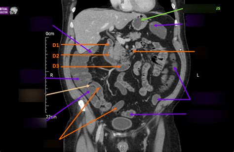 Mri Lower Abdomen Iii Diagram Quizlet