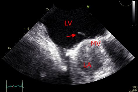 Medically Managed Prosthetic Valve Endocarditis Caused By Salmonella