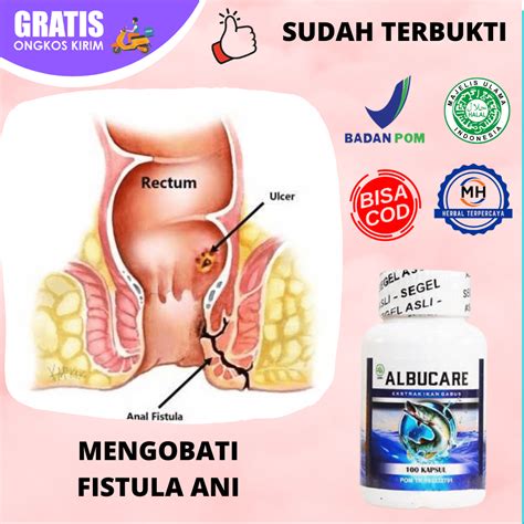 Penyakit Fisura Ani Berdasarkan Data Medis Tercatat 150 Ribu Orang