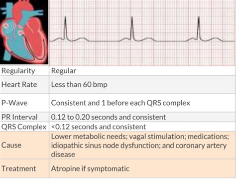 Ekg Rhythms Flashcards Quizlet