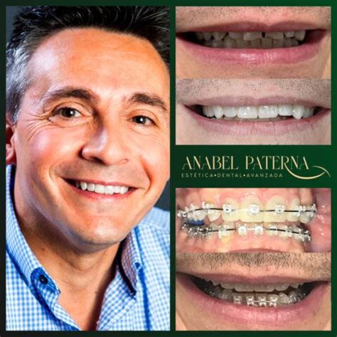 Antes y después Ortodoncia Anabel Paterna Clínica Dental
