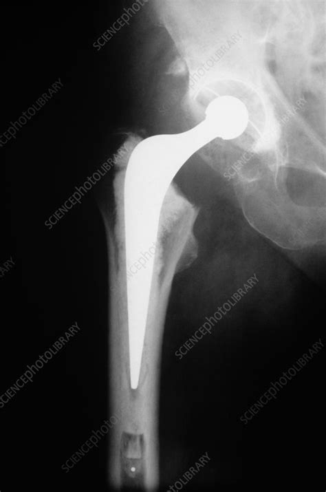 Total Hip Replacement X Ray Stock Image C003 6311 Science Photo