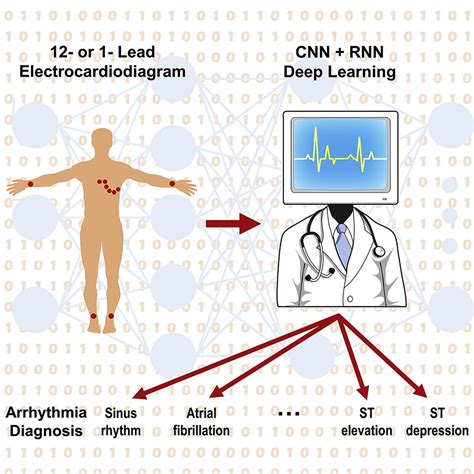 detection and classification of cardiac arrhythmias by a challenge best deep learning neural