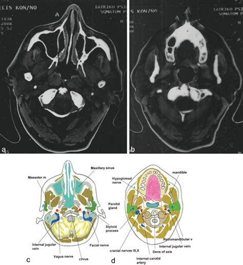 Ct Anatomy Of Neck Anatomical Charts Posters The Best Porn Website