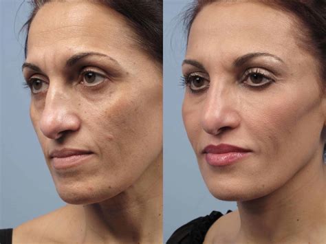 Fractional Laser Before And After Laser Facial Before And After Emerge