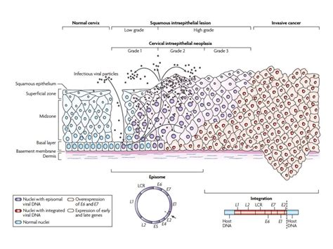 Using Human Papillomavirus HPV Detection Tests For Cervical Cancer