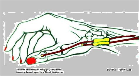 De Quervains Tenosynovitis Syndrome Causes Diagnosis Treatment