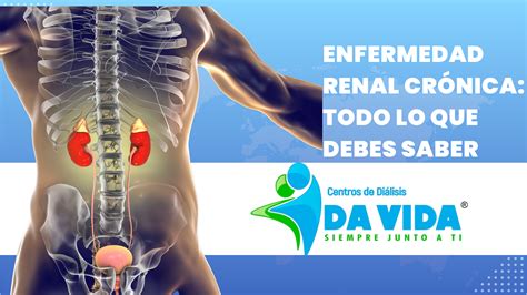 Enfermedad renal crónica todo lo que debes saber Davida