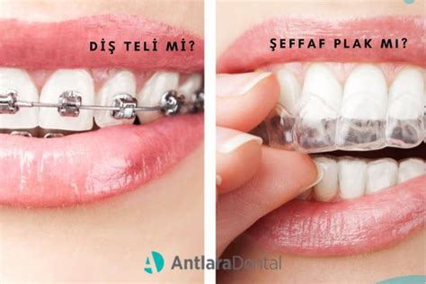 Diş Teli mi Şeffaf Plak mı Hangisi İyi Antalya Antlara Dental