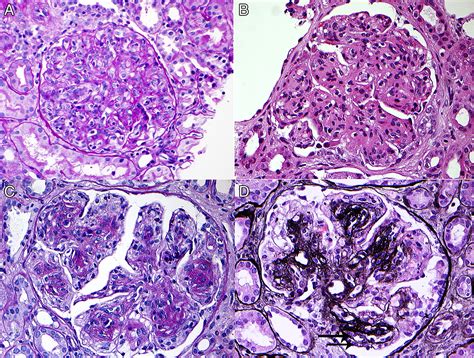 Etiology Based Diagnostic Approach To Proliferative Glomerulonephritis