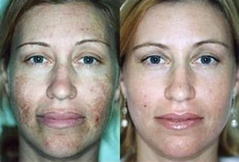 Peelling De Fenol Antes E Depois Pre O Pros E Contras