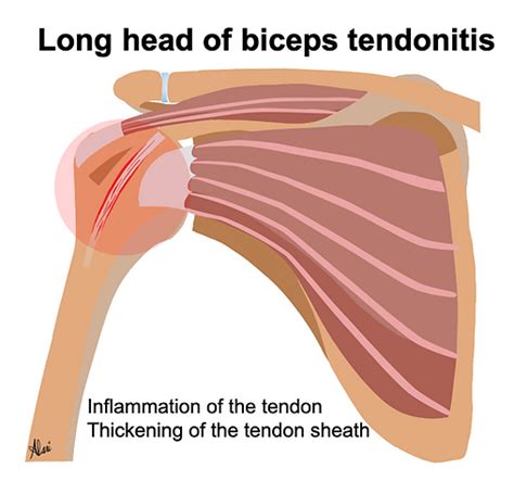 Long Head Of Biceps Tendon Sheath Cortisone Injection Musculoskeletal