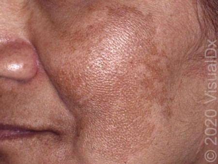 White Spots On The Skin Possible Causes And Treatments