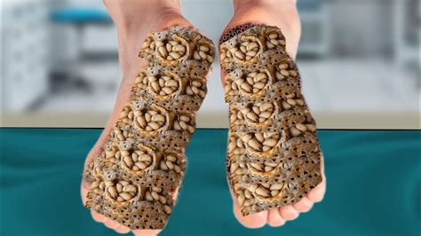 Asmr Remove Maggots Worm Infected Foot Deep Cleaning Animation